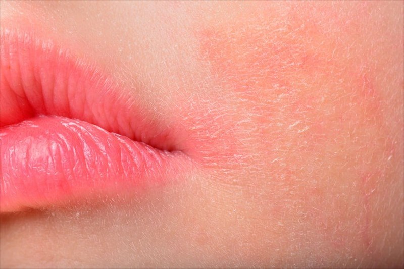 What Are The Causes And Risk Factors For Eczema Atopic Dermatitis